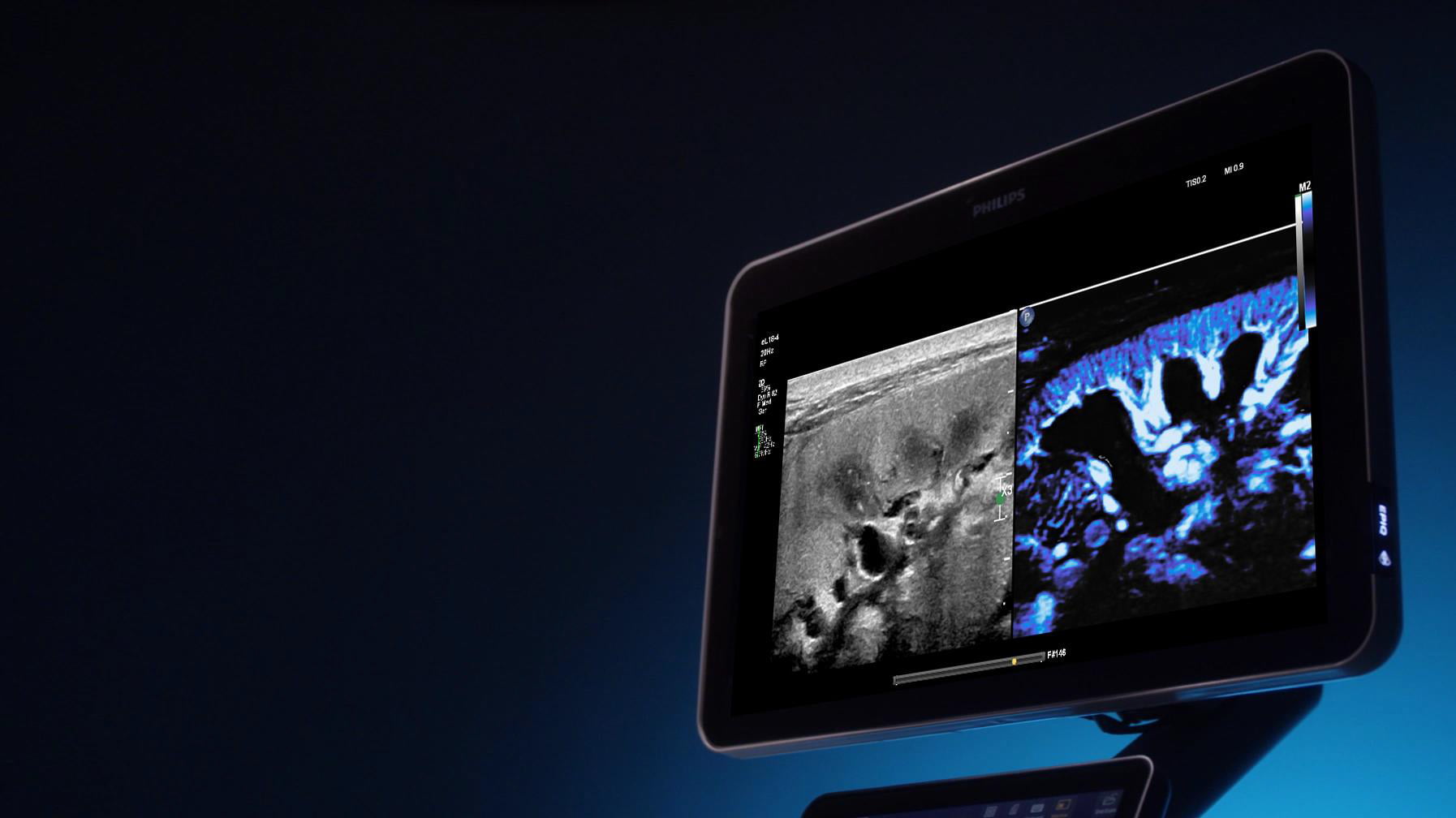 Ultrassom Philips EPIQ Elite